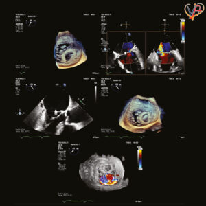 Percutaneous Mitral Valve Repair with the PASCAL Ace System in an Older ...